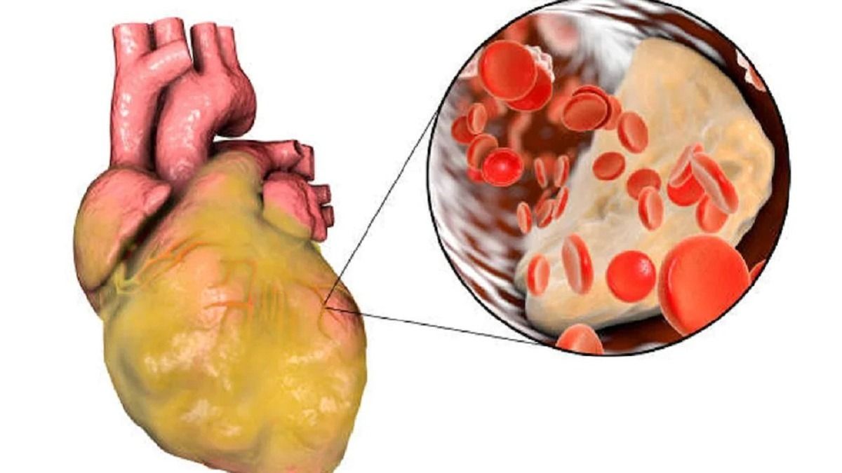 Blood Group- Cardiac Arrest: A B AB O- কোন ব্লাড গ্রুপের মানুষদের হার্ট ...