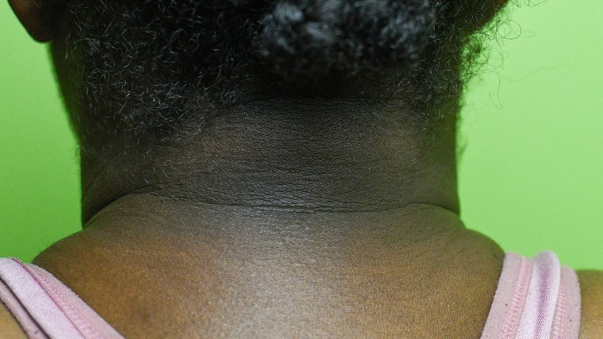 Dark Neck Remedies - Dark Neck Remedies: ঘাড়ের বিশ্রি কালো দাগ উঠে ...