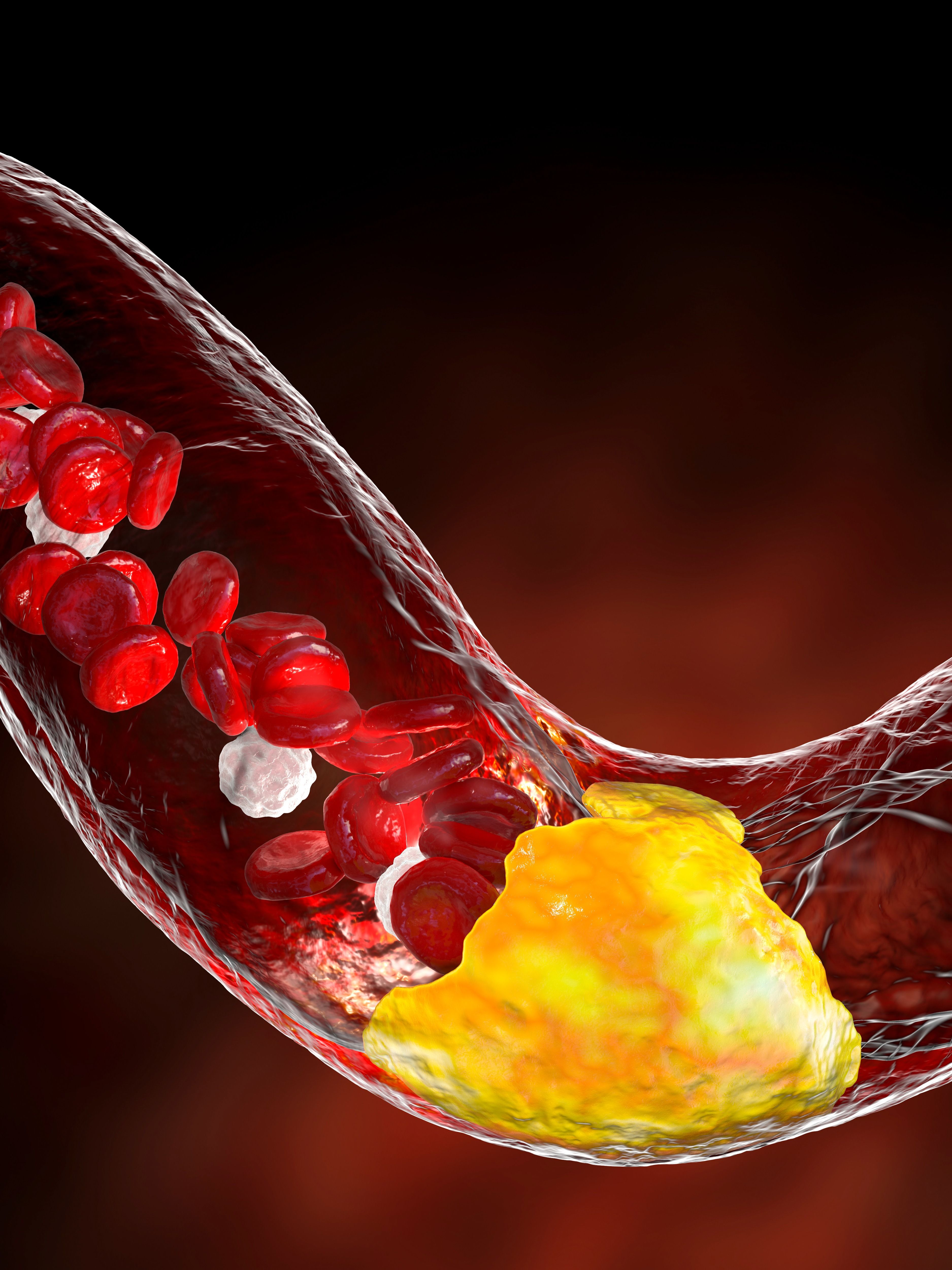 हाथ में महसूस हो ऐसा तो समझें बढ़ गया है कोलेस्ट्रॉल! - High ...