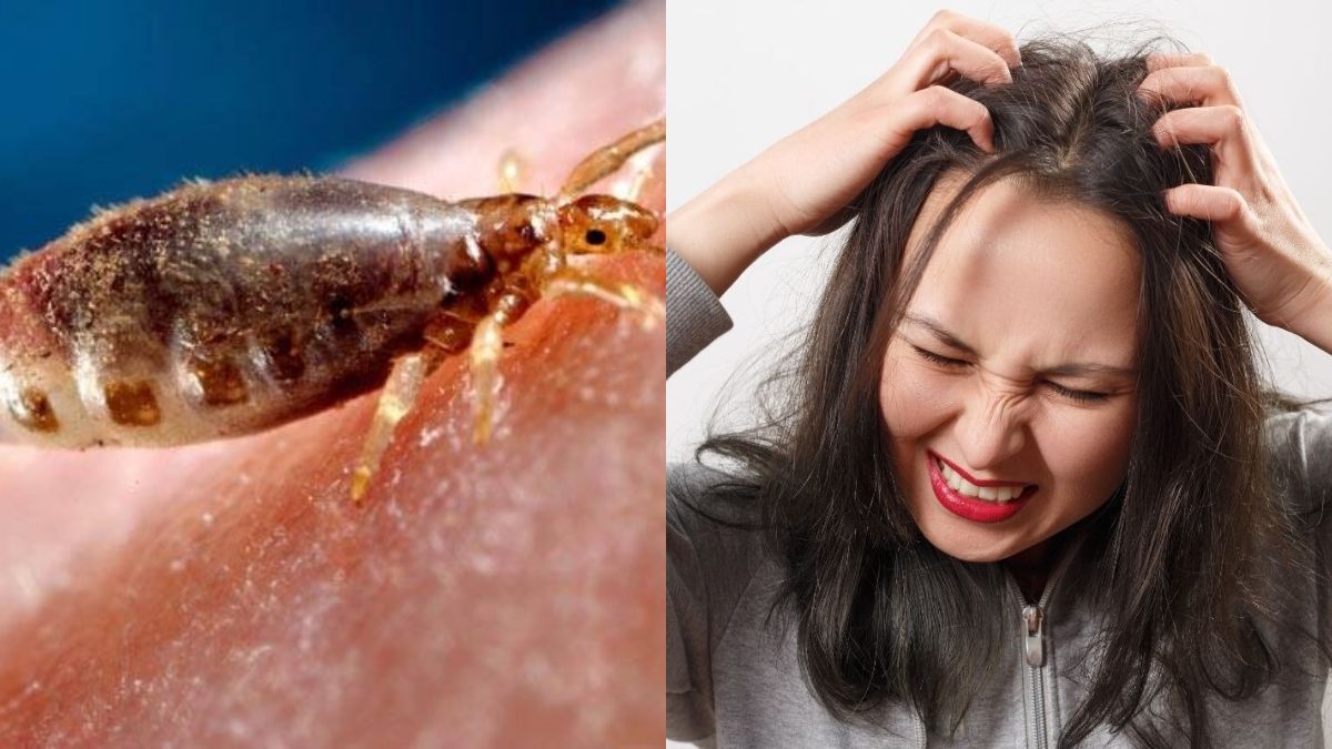 തലയിലെ ചോരയൂറ്റി കുടിക്കുന്ന ഡ്രാക്കുള! പേൻ ശല്യം അകറ്റാൻ ഉപ്പിലുണ്ട് ...