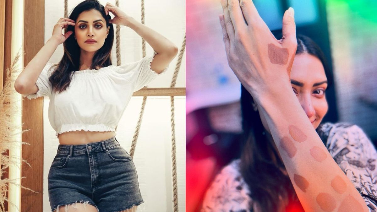 വിറ്റിലിഗോ ദിനത്തിൽ രോഗാവസ്ഥ തുറന്നുകാട്ടി മംമ്ത മോഹൻദാസ്